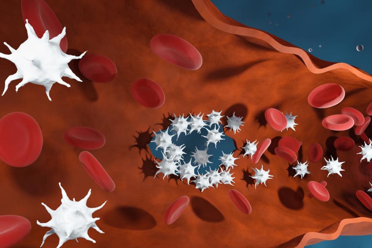 Paroxysmal Nocturnal Hemoglobinuria