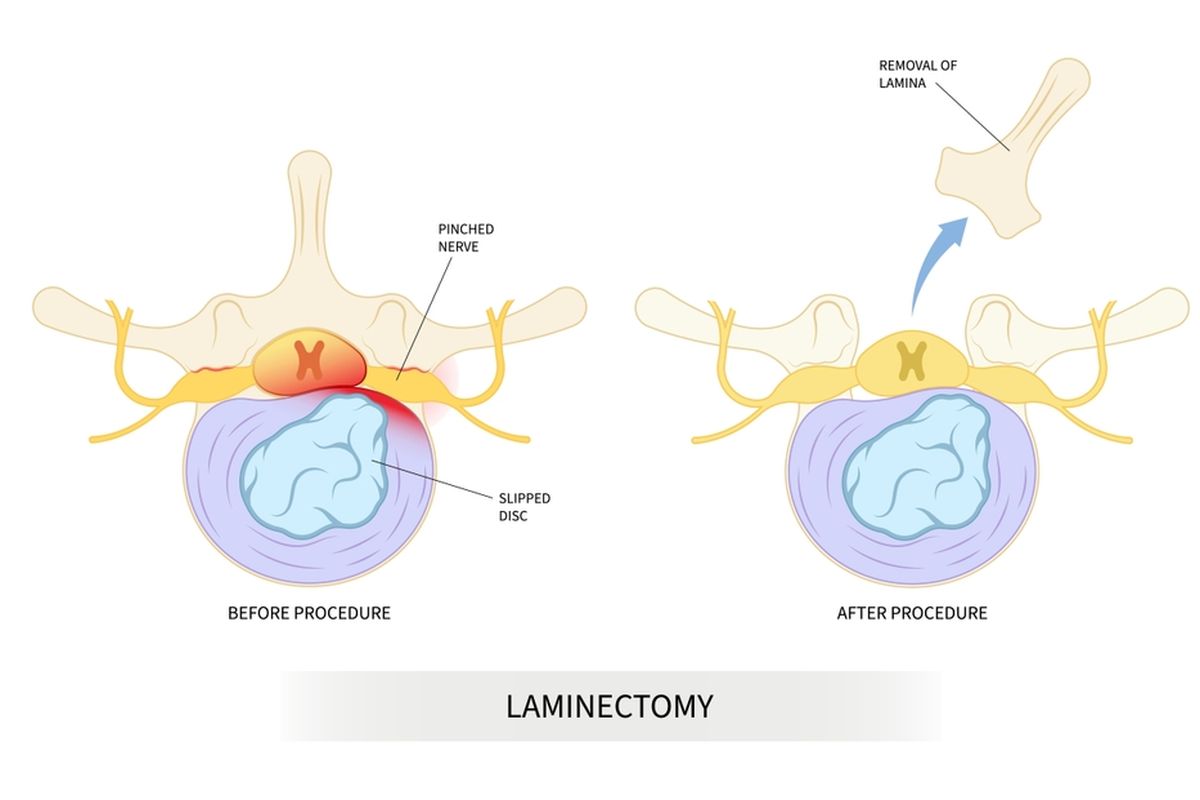 Laminectomy Surgery- Meaning, Procedure & Cost In India