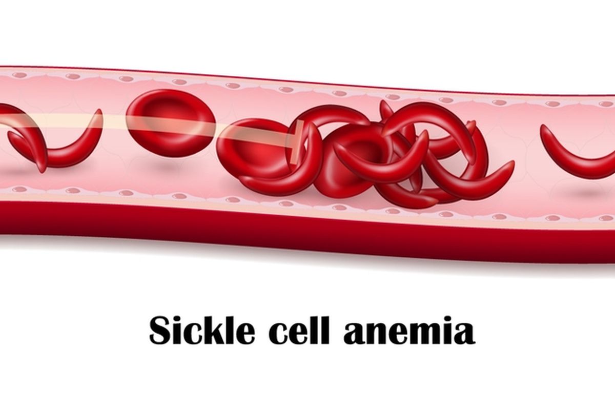 Sickle Cell Anemia Symptoms Treatment Options Causes More